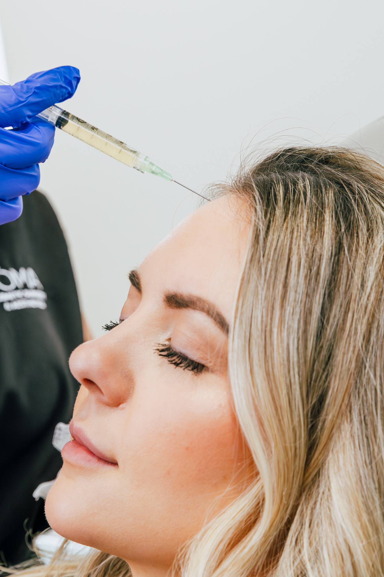 Hair Restoration in Des Moines | SOMA Cosmetic Surgery & Aesthetics